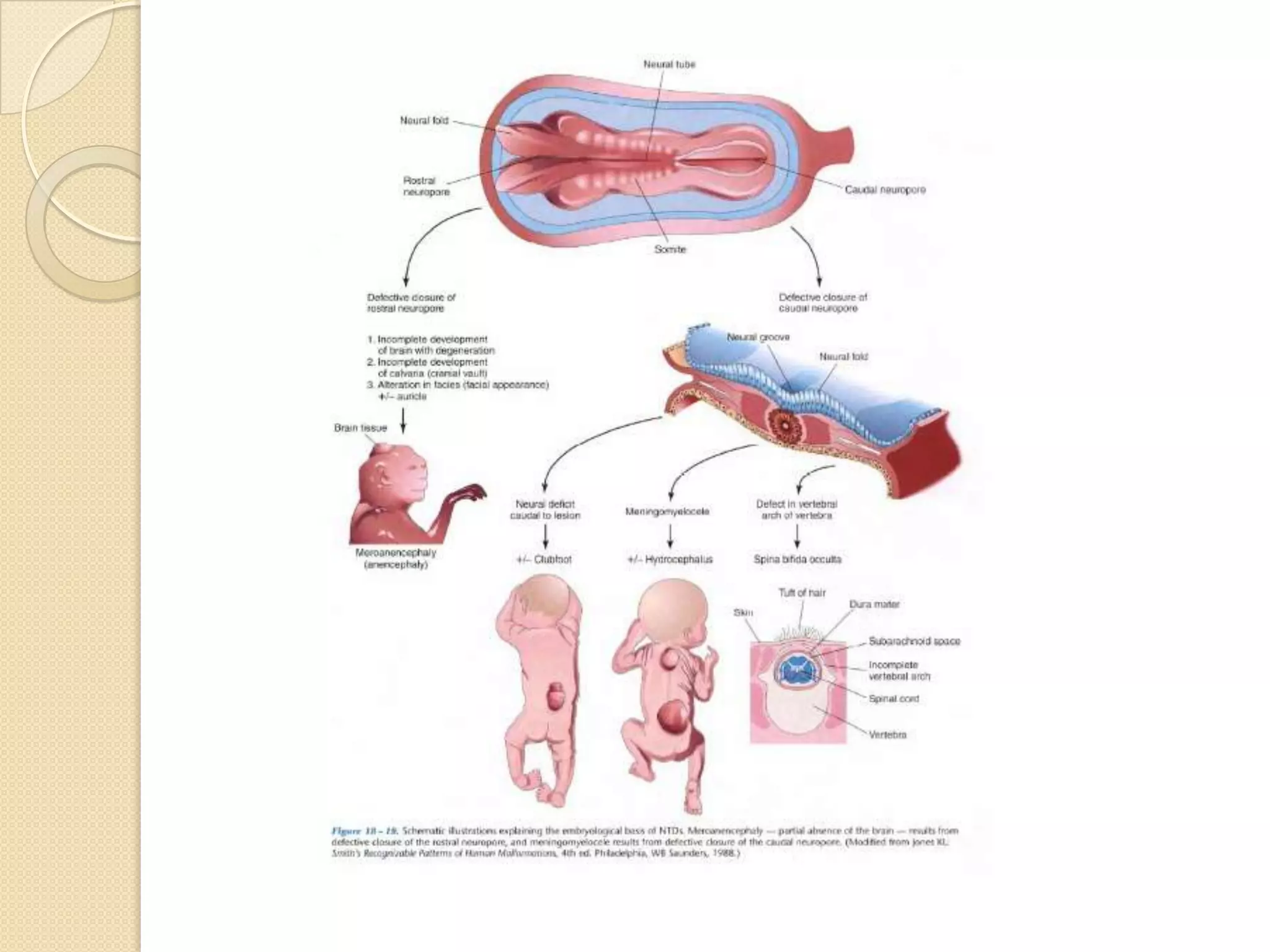 Disorders of neural tube closure and neuronal migration | PPTX