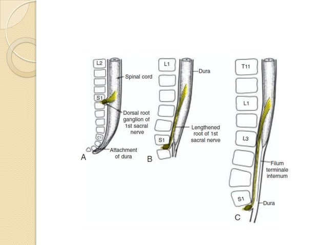 Disorders of neural tube closure and neuronal migration | PPTX