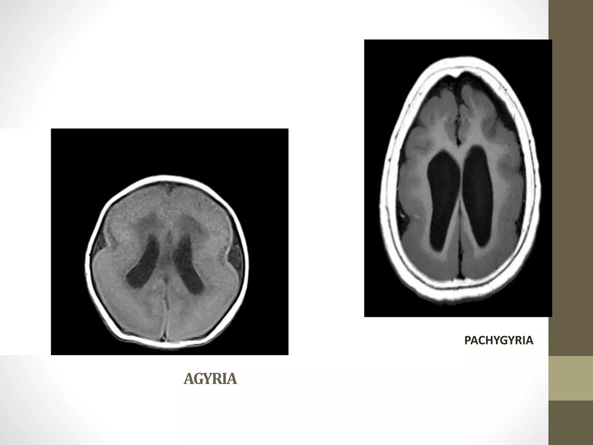 Disorders of neuronal migration | PPTX