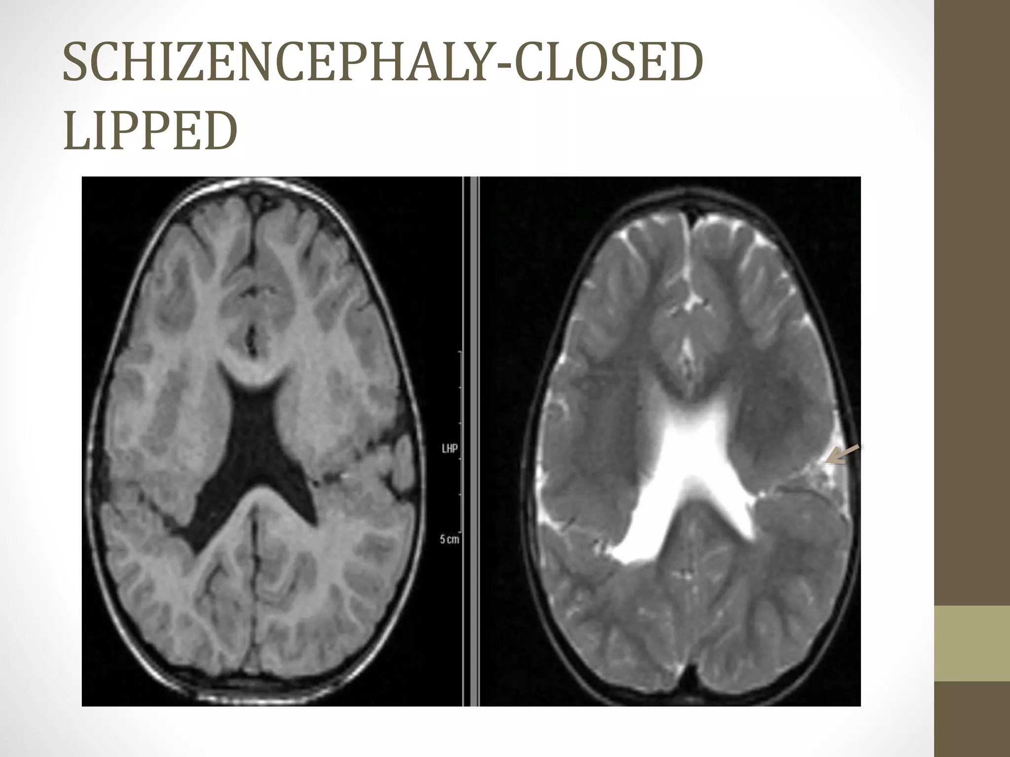 Disorders of neuronal migration | PPTX