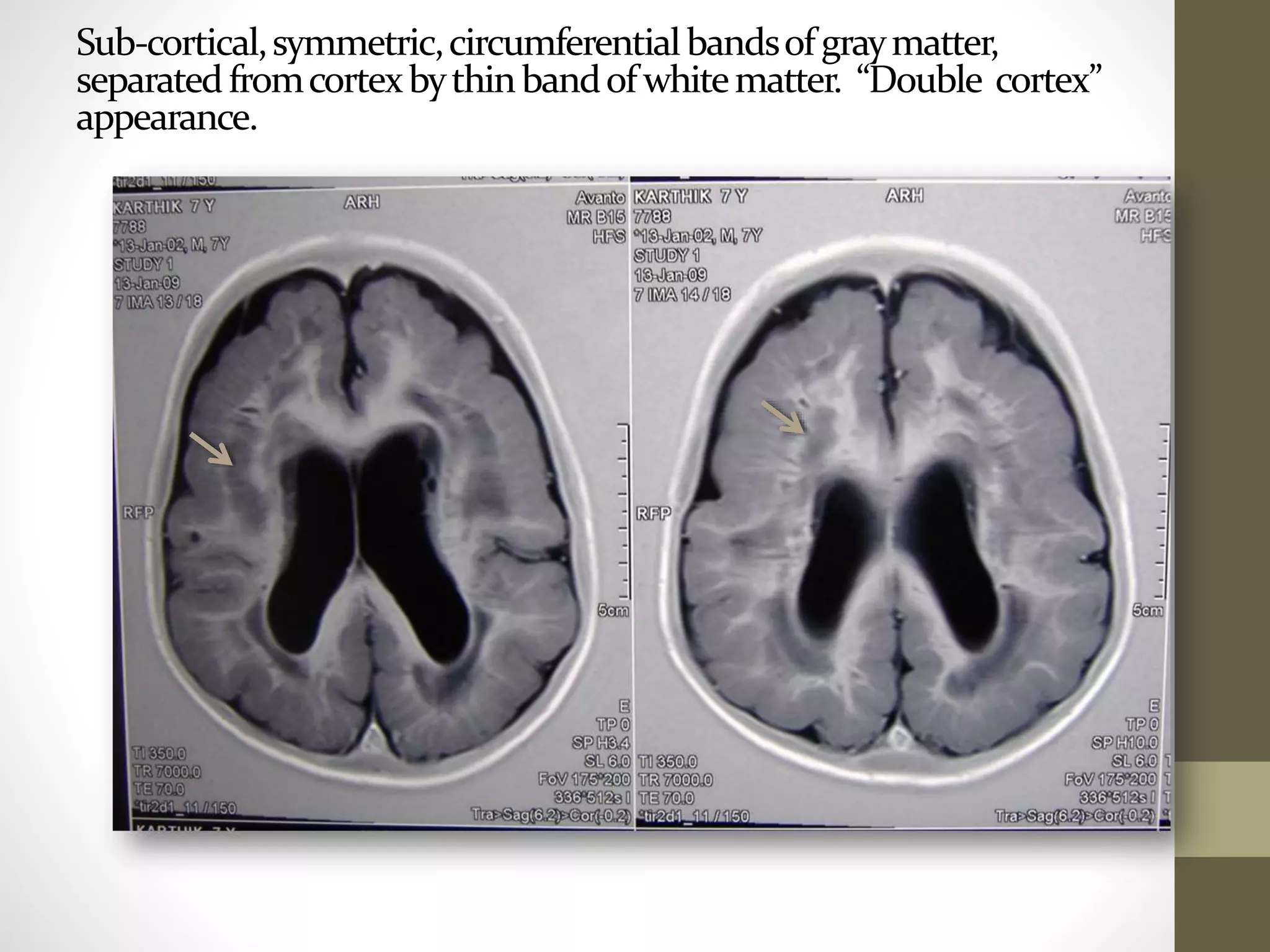 Disorders of neuronal migration | PPTX