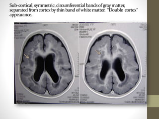 Disorders of neuronal migration | PPTX