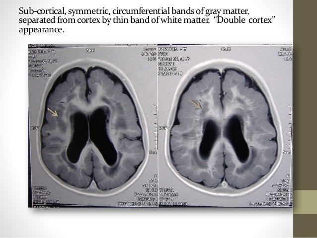 Disorders of neuronal migration