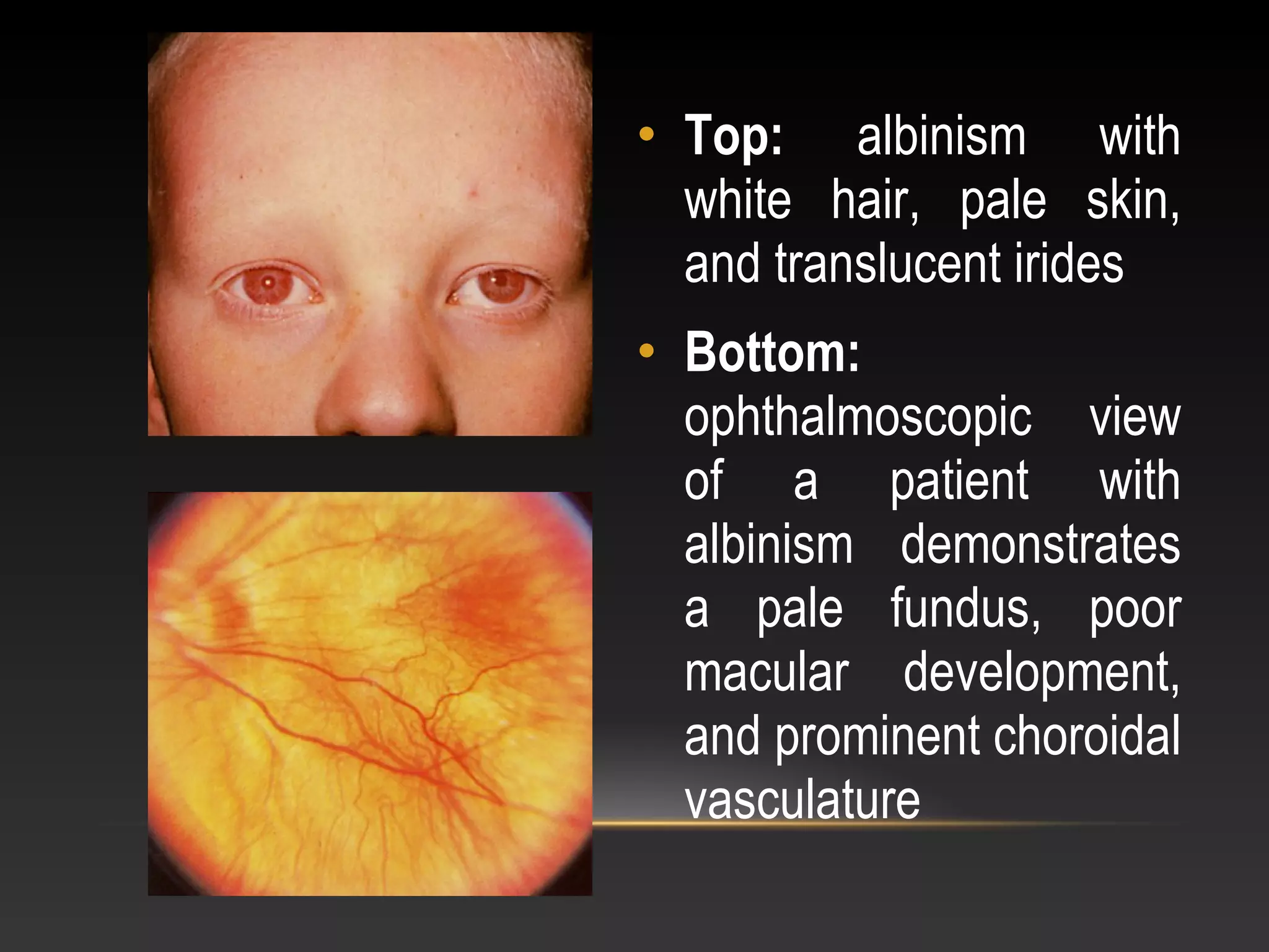 Disorders of pigmentation | PPT
