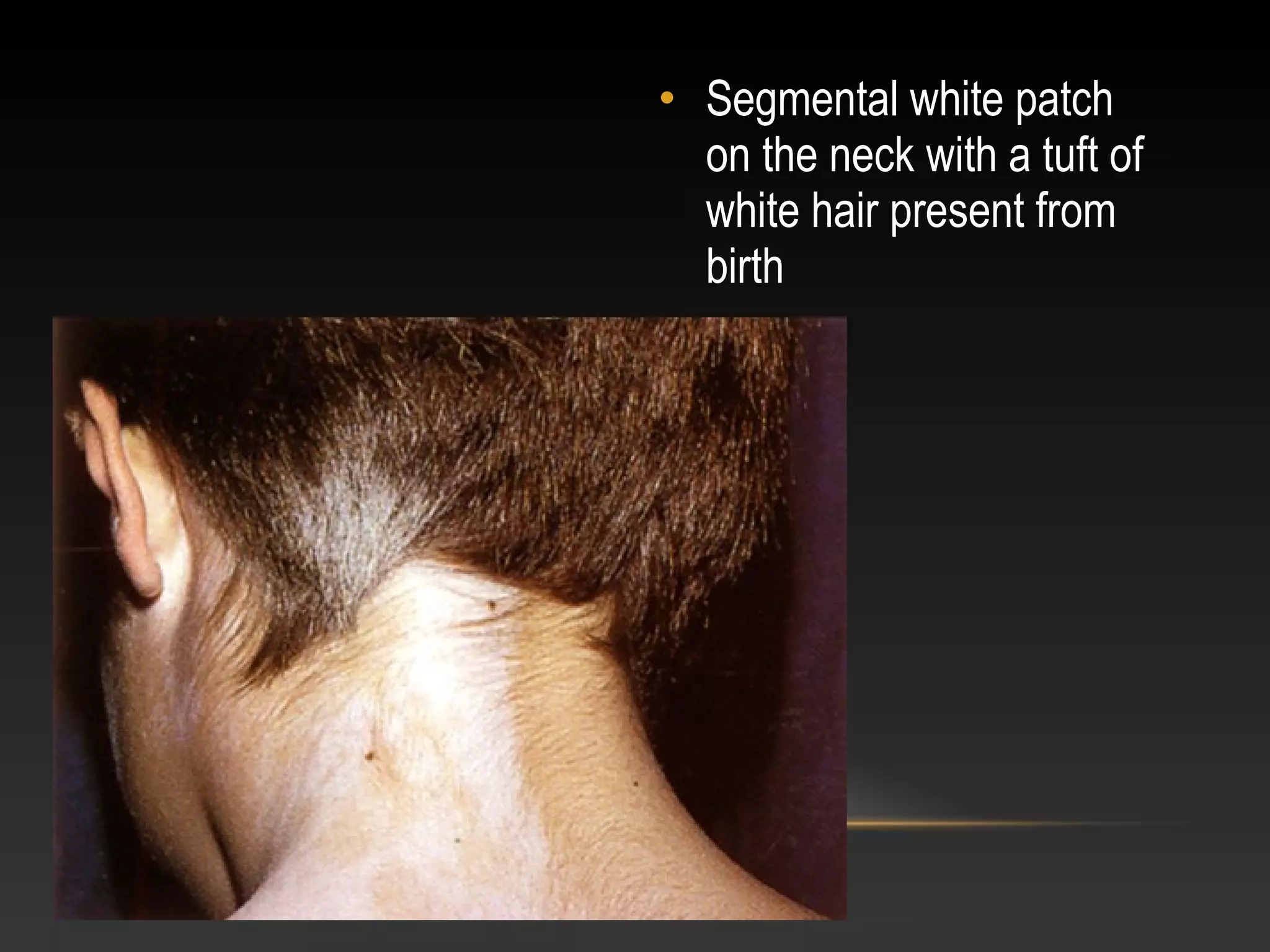 Disorders of pigmentation | PPT