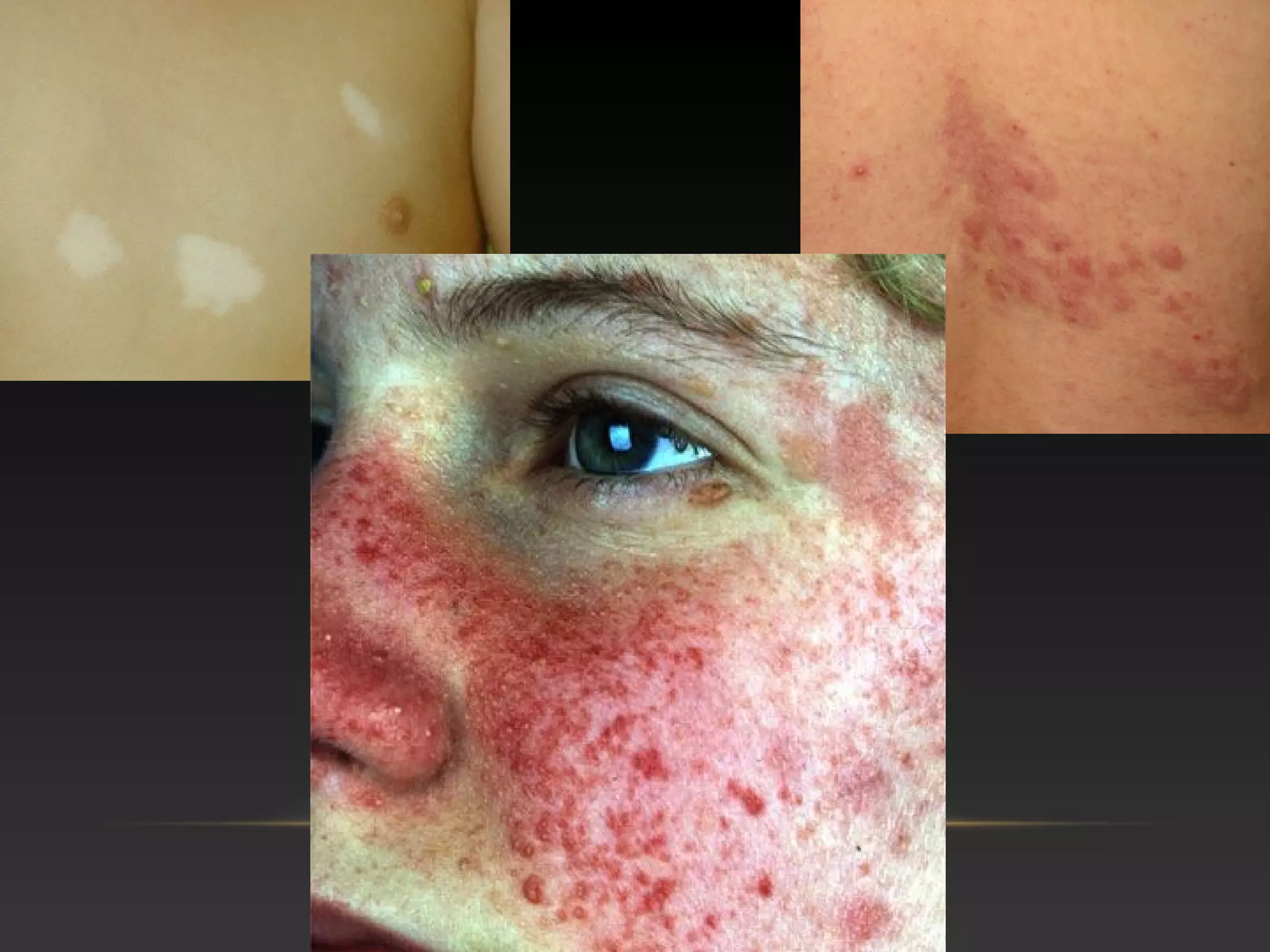 Disorders of pigmentation | PPT