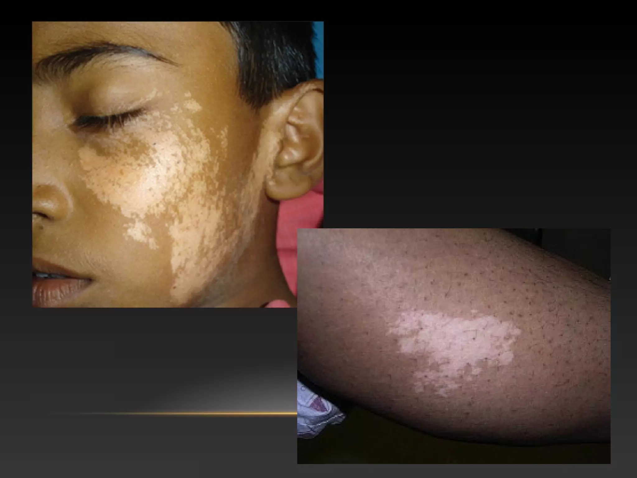 Disorders of pigmentation | PPT