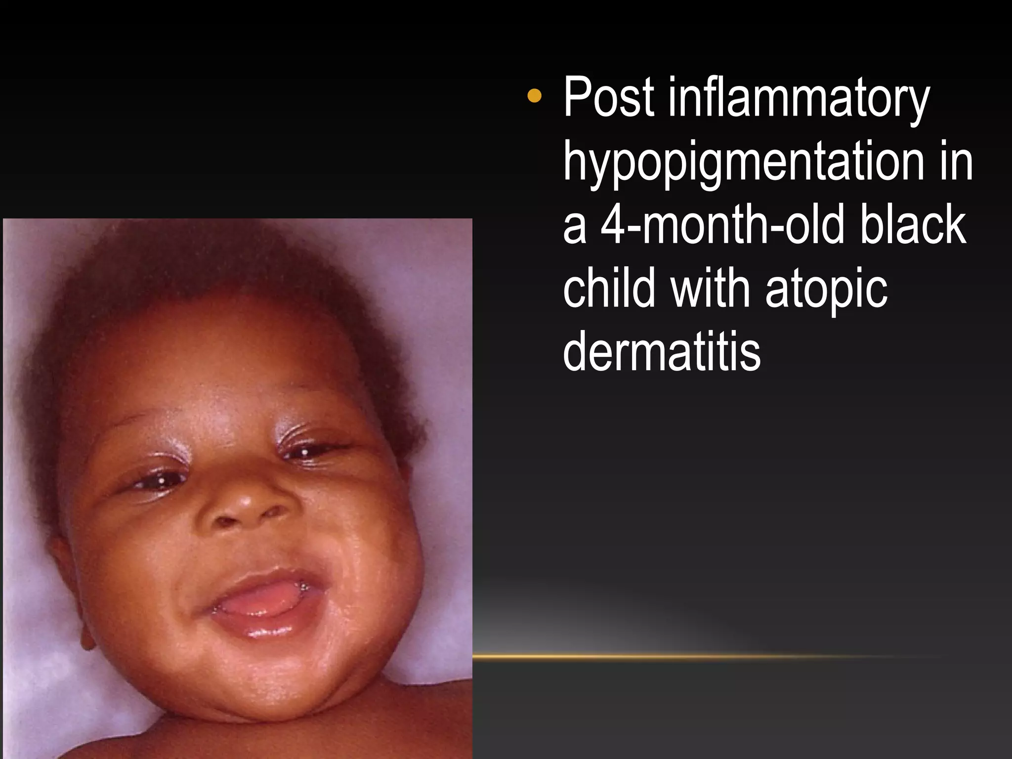 Disorders of pigmentation | PPT