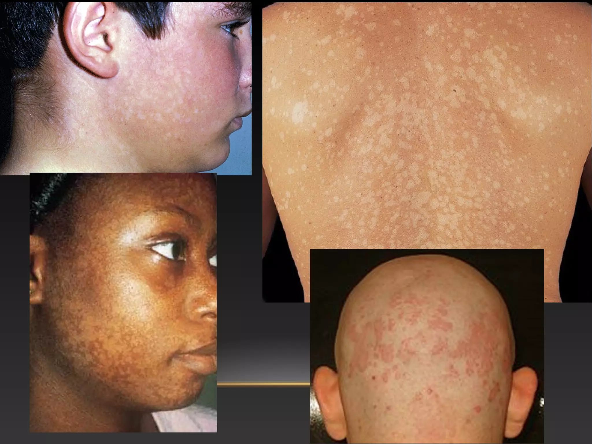 Disorders of pigmentation | PPT