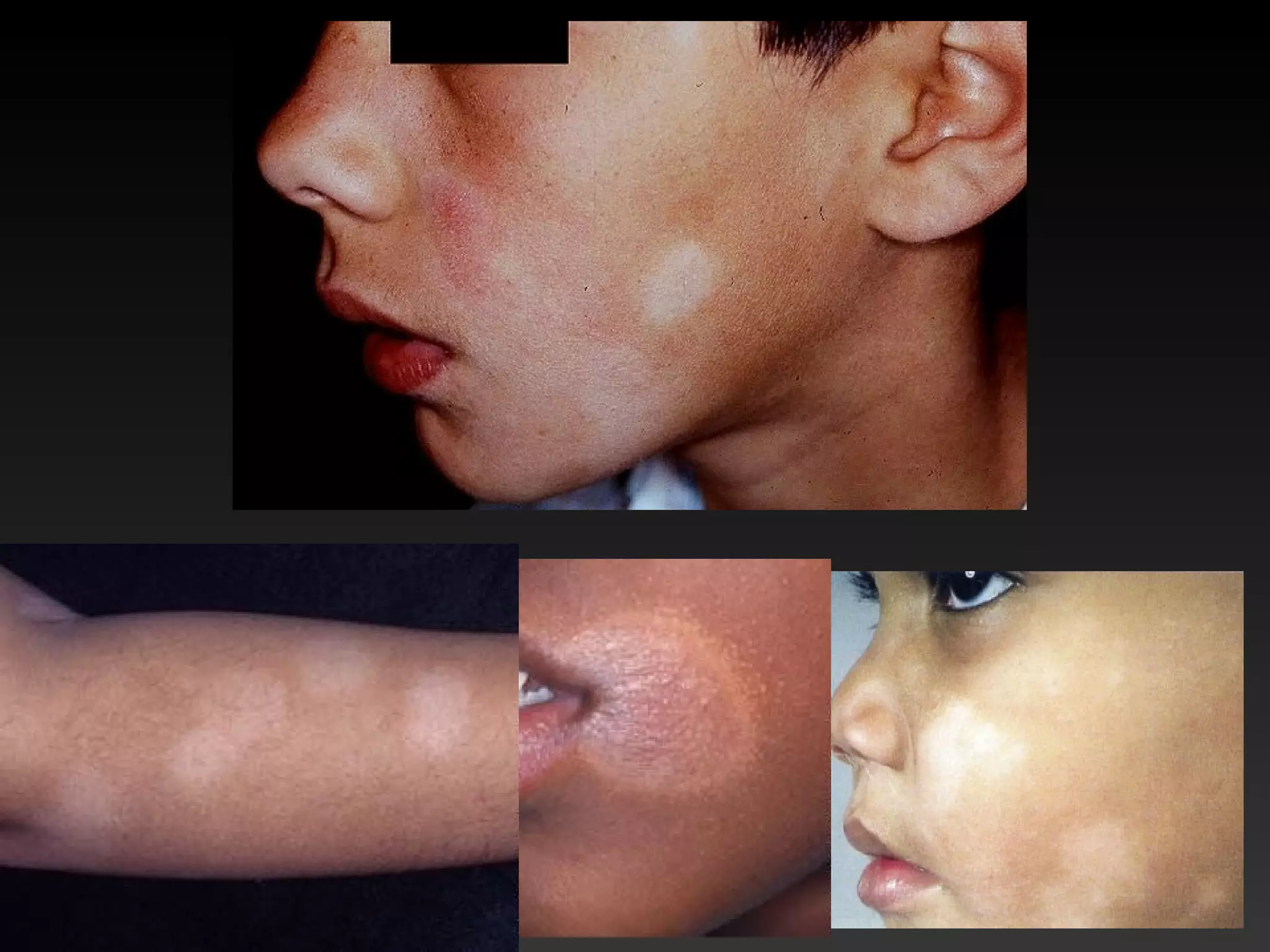 Disorders of pigmentation | PPT