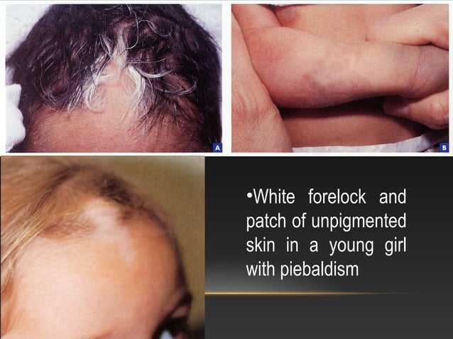 Disorders of pigmentation | PPT | Skin and Dermatology | Diseases and ...