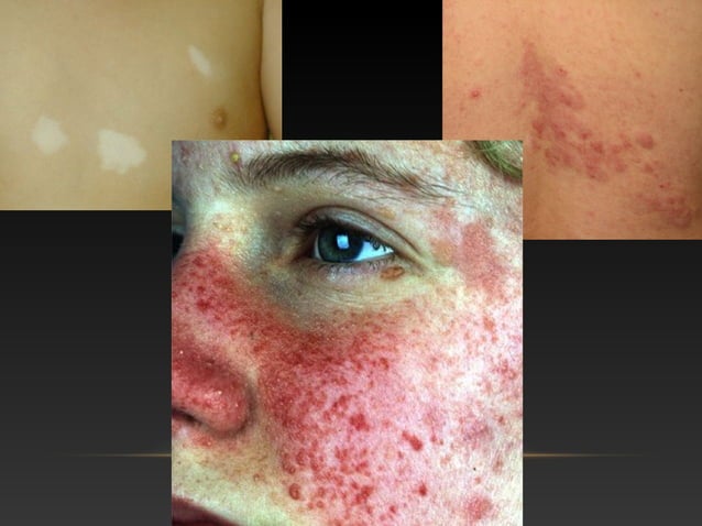 Disorders of pigmentation | PPT | Skin and Dermatology | Diseases and ...
