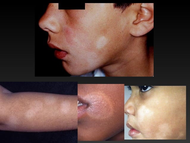 Disorders of pigmentation | PPT | Skin and Dermatology | Diseases and ...