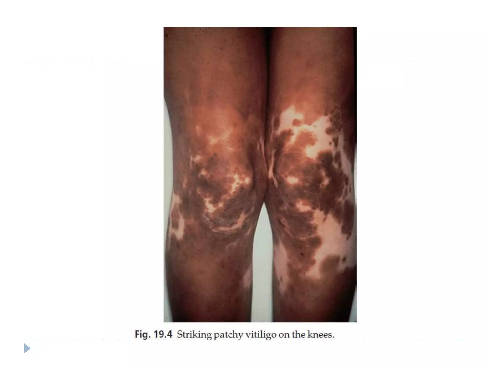 Disorders of pigmentation | PPTX