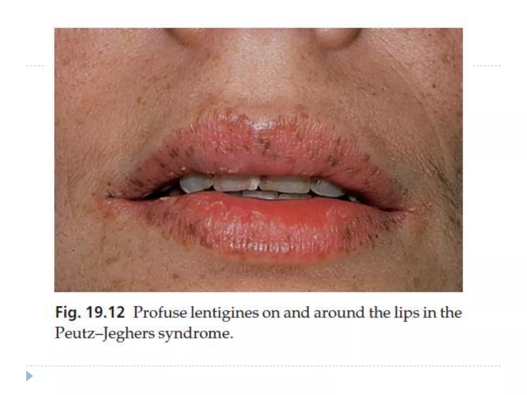 Disorders of pigmentation | PPTX