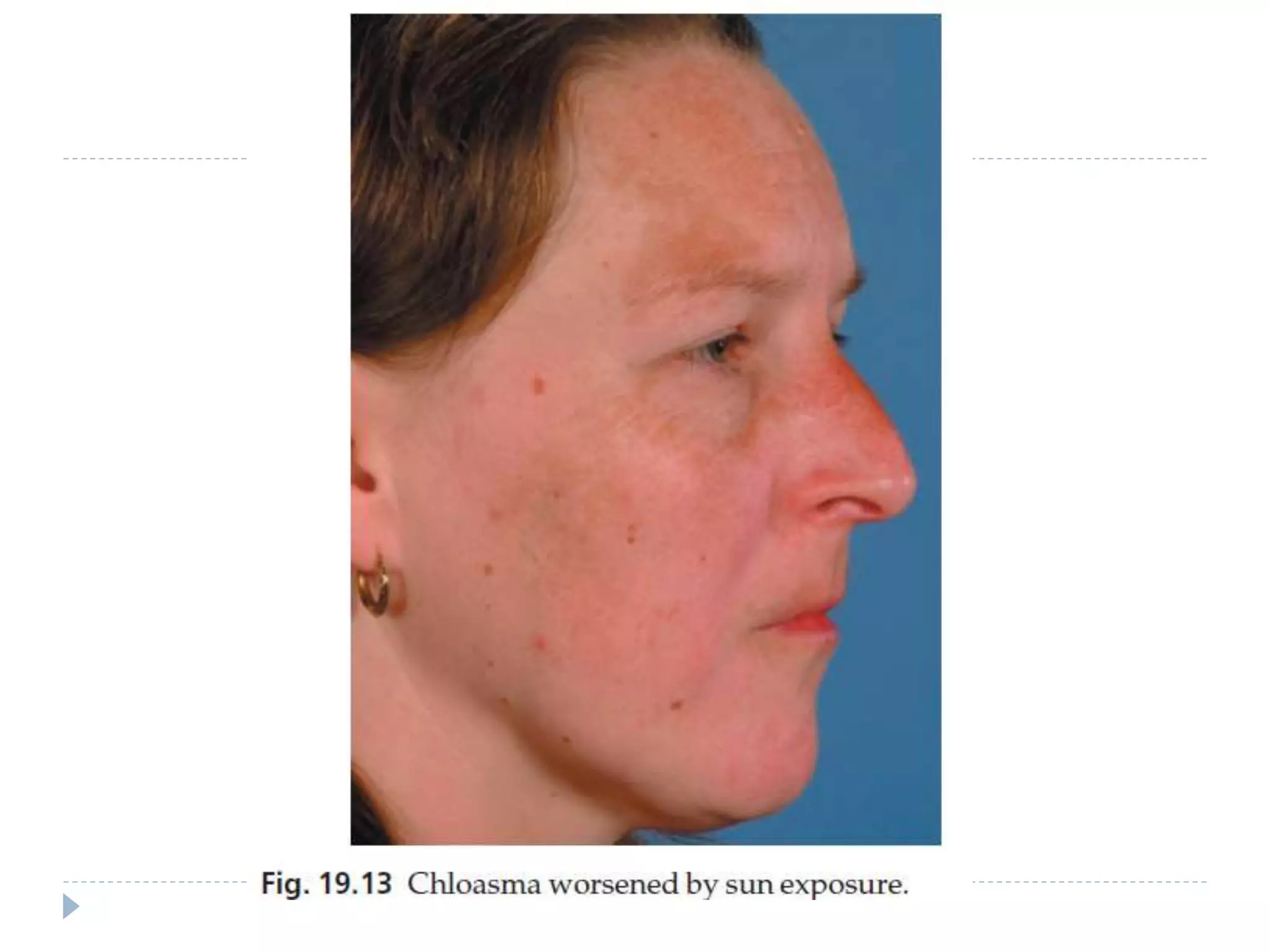 Disorders of pigmentation | PPTX