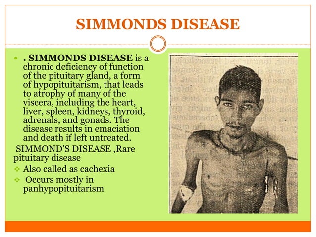 DISORDERS OF PITUITARY G.pptx | Hormonal Disorders | Endocrine and ...