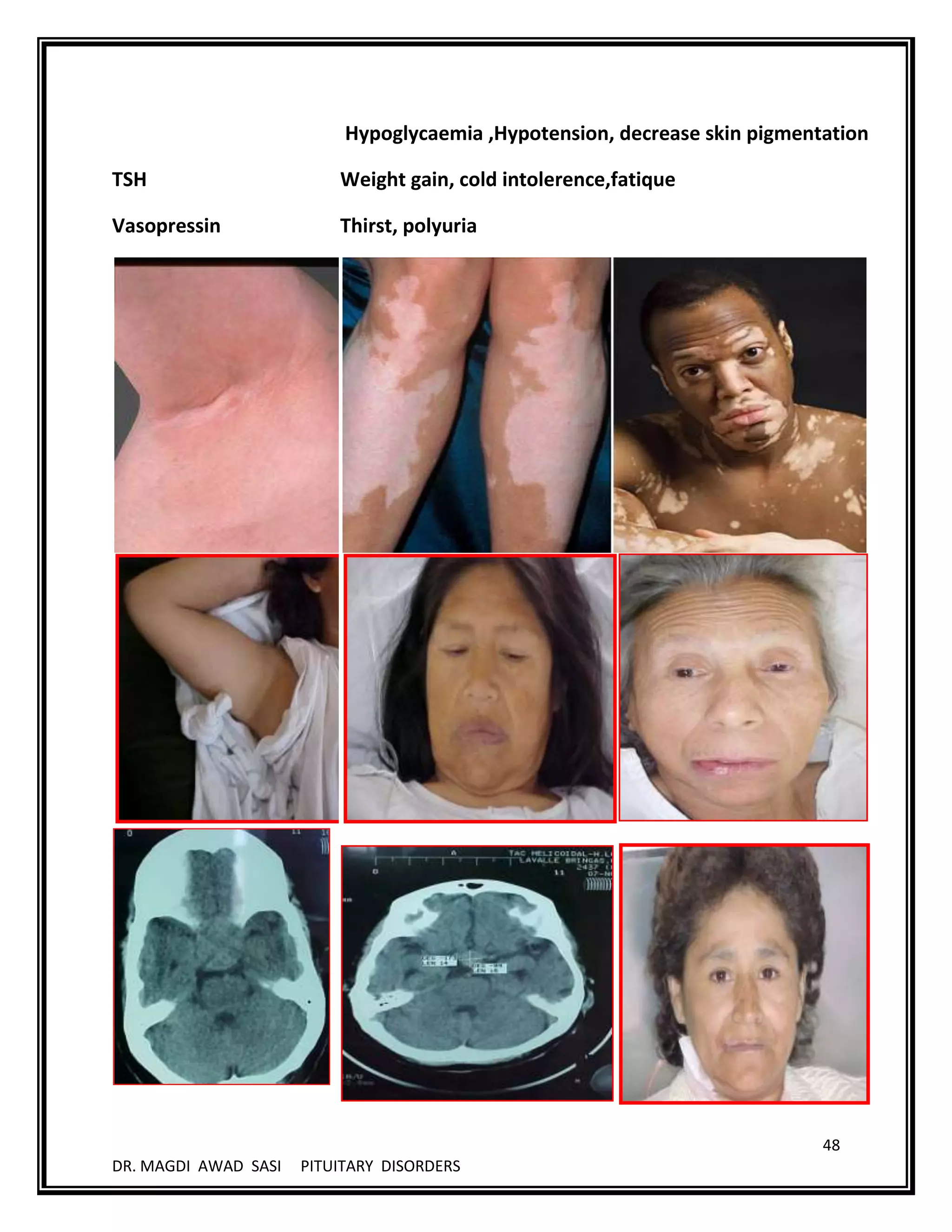 Disorders Of Pituitary Gland The Master By Msasi