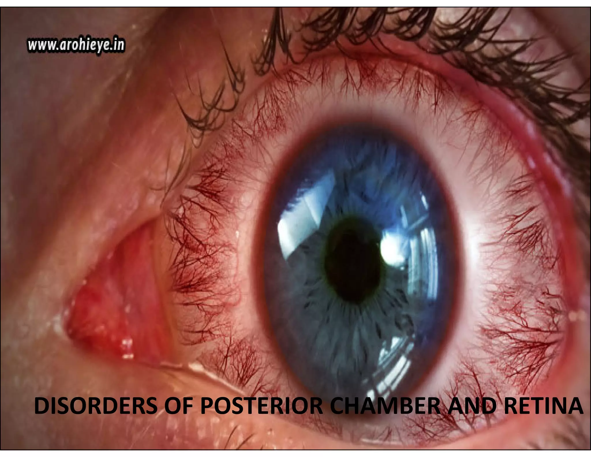 disorders of posterior chamber and retina -retinal and vitereous ...