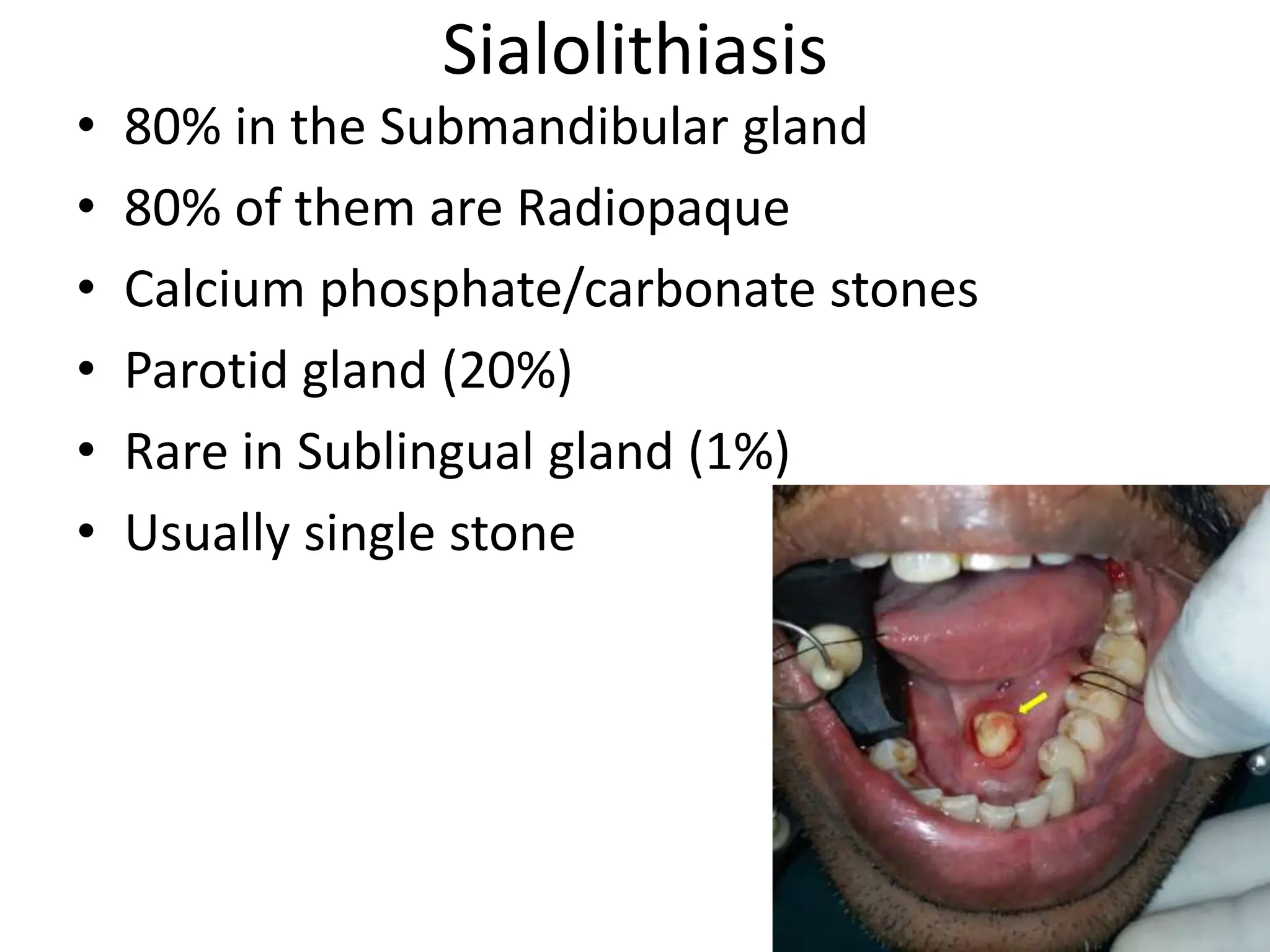DISORDERS OF SALIVARY GLANDS-1- tumors,stones | PPTX