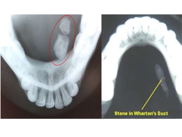 DISORDERS OF SALIVARY GLANDS-1- tumors,stones | PPTX