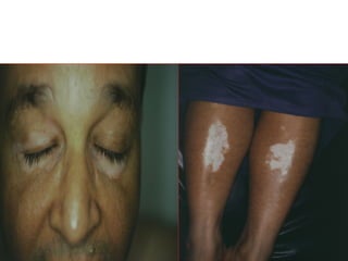 dermatology.Disorders of skin color.(dr.ali) | PPT