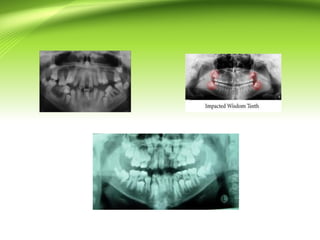 Disorders of teeth | PPT