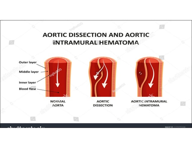Disorders of the aorta OM VERMA 2022...pdf