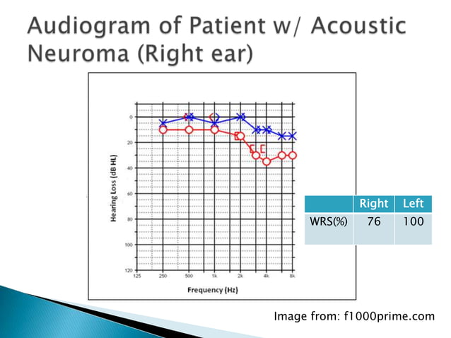 Disorders of the auditory nervous system | PPTX