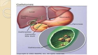 Disorders of the biliary tract | PPTX | Digestive Disorders | Diseases ...