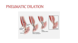 Disorders of the esophagus.pptx
