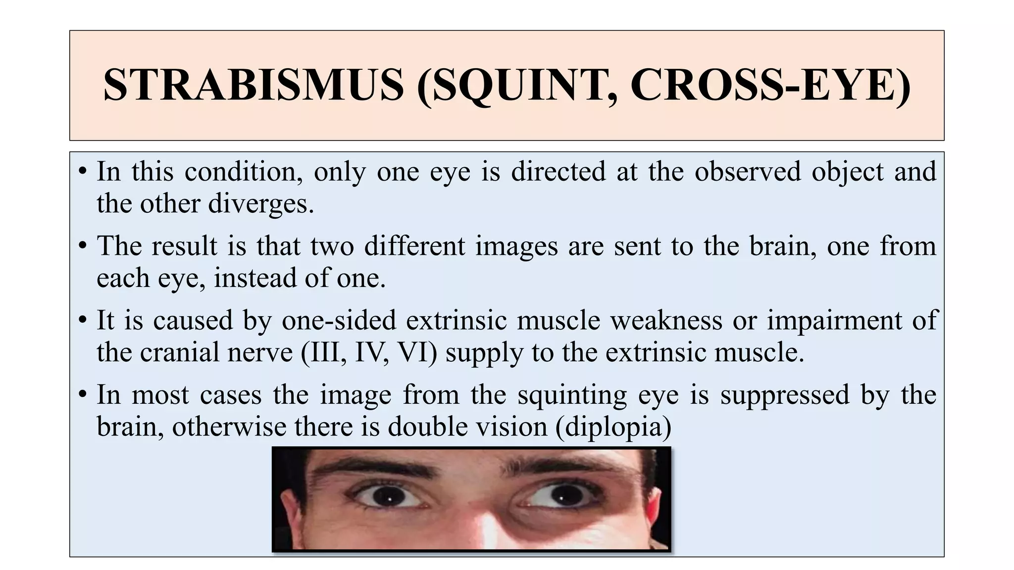 Disorders of the eye | PPTX