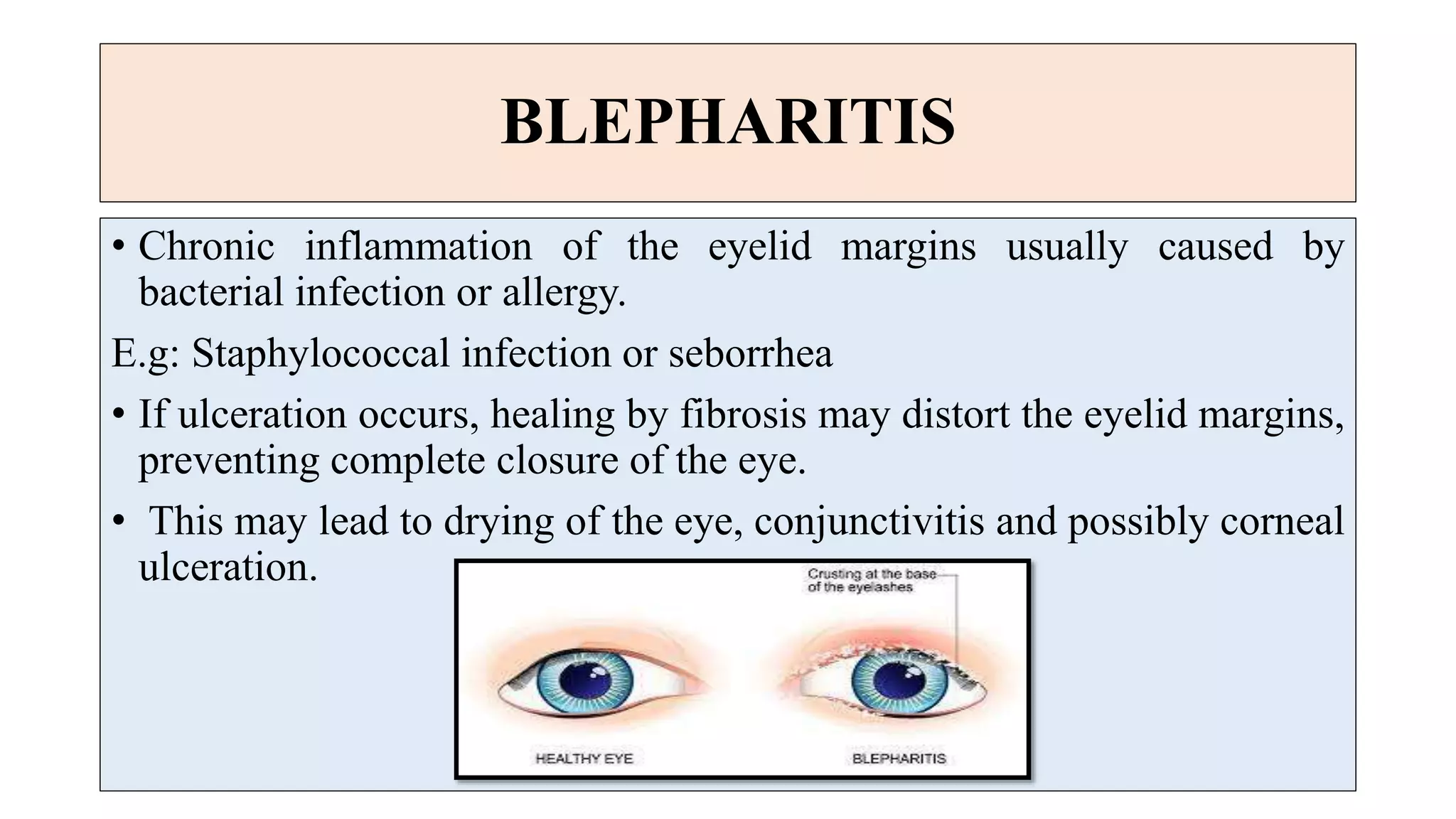 Disorders of the eye | PPTX