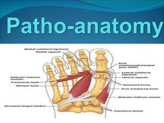 Disorders of the hallux | PPT