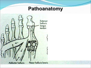 Disorders of the hallux | PPT