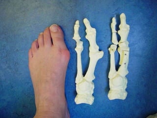 Disorders of the hallux | PPT