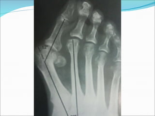 Disorders of the hallux | PPT