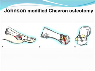 Disorders of the hallux | PPT