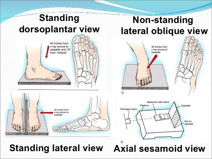 Disorders of the hallux