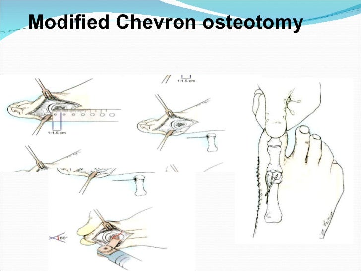 Disorders of the hallux