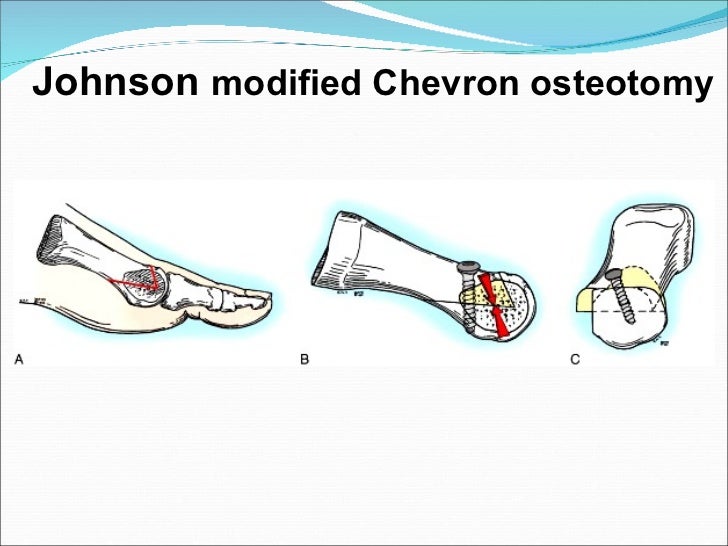 Disorders of the hallux