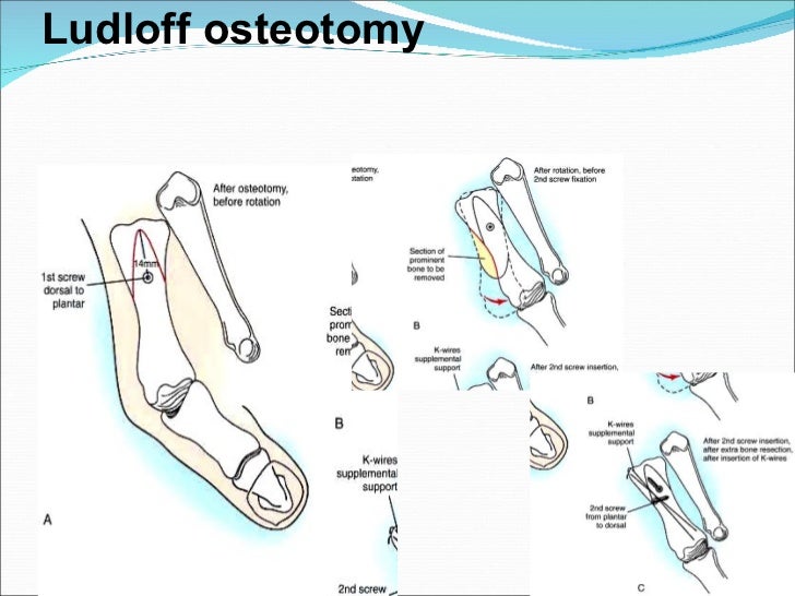 Disorders of the hallux