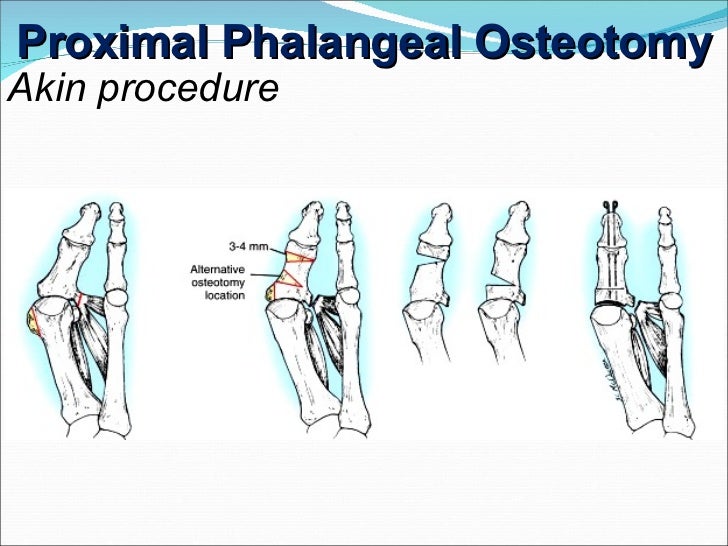 Disorders of the hallux