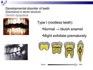 Disorders of the teeth & bone | PPT