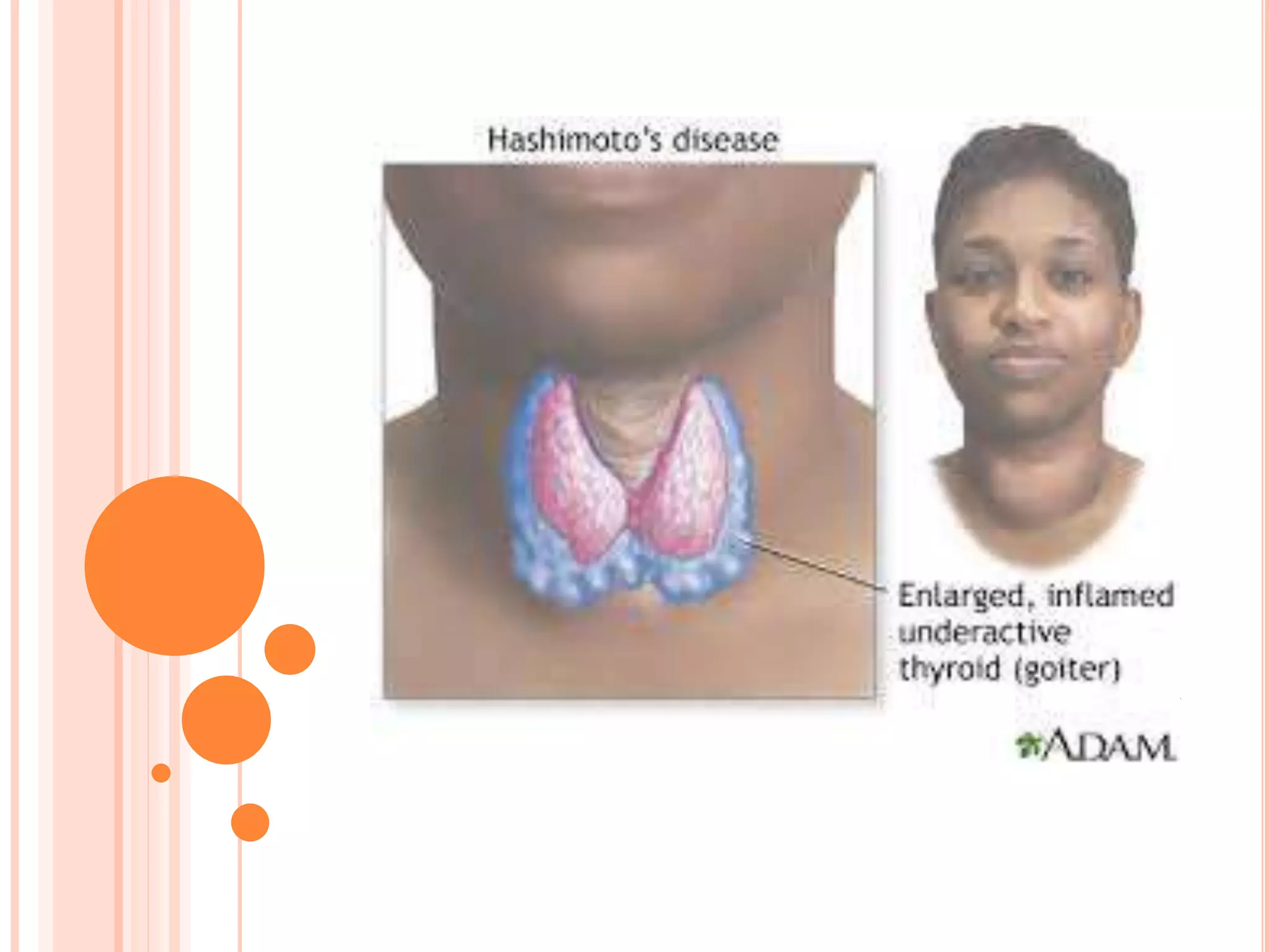 Disorders of the thyroid gland | PPTX
