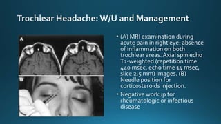 Disorders of the trochlear nerve | PPT