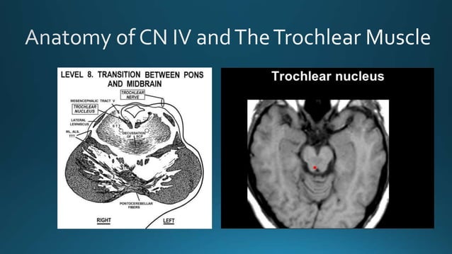 Disorders of the trochlear nerve | PPT