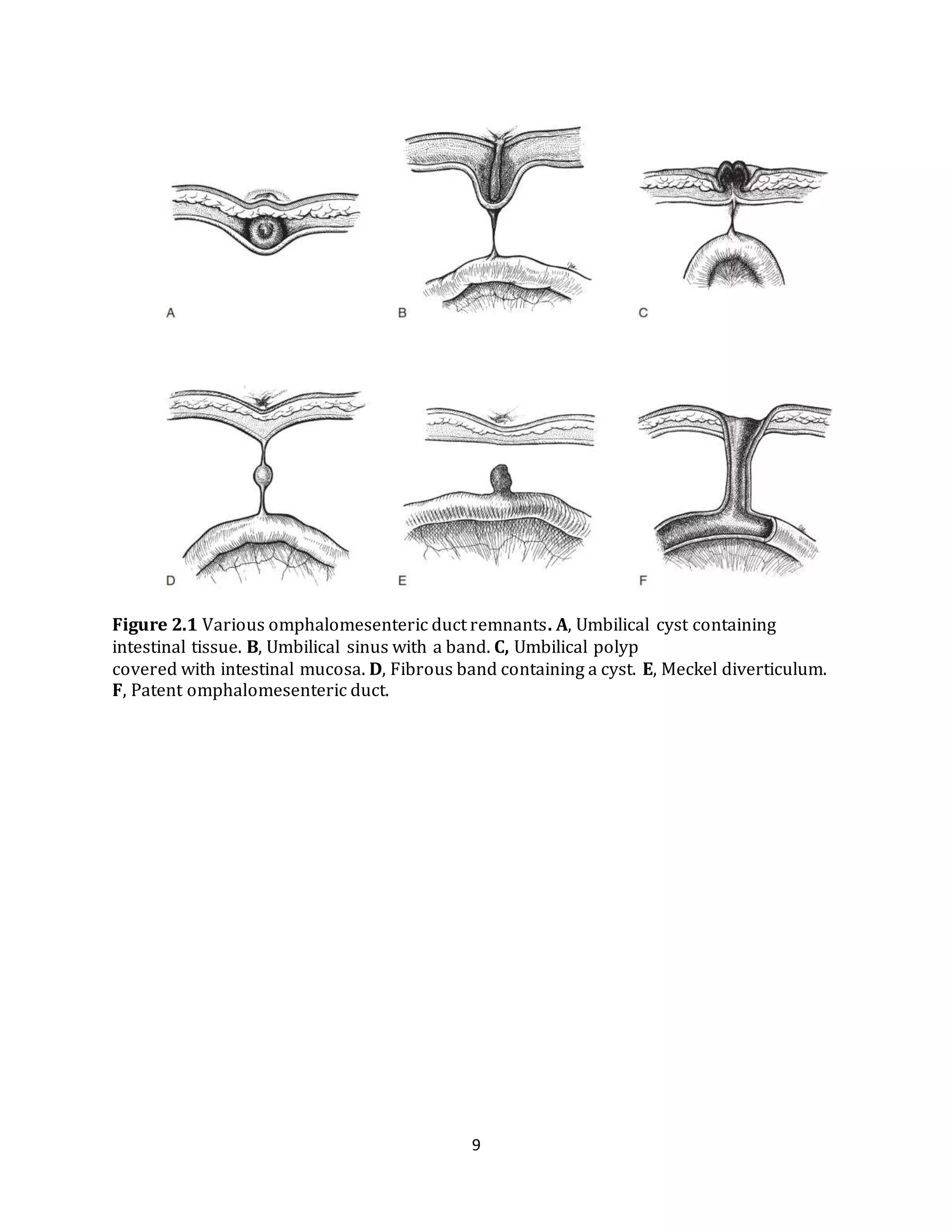 Omphalomesenteric Cyst
