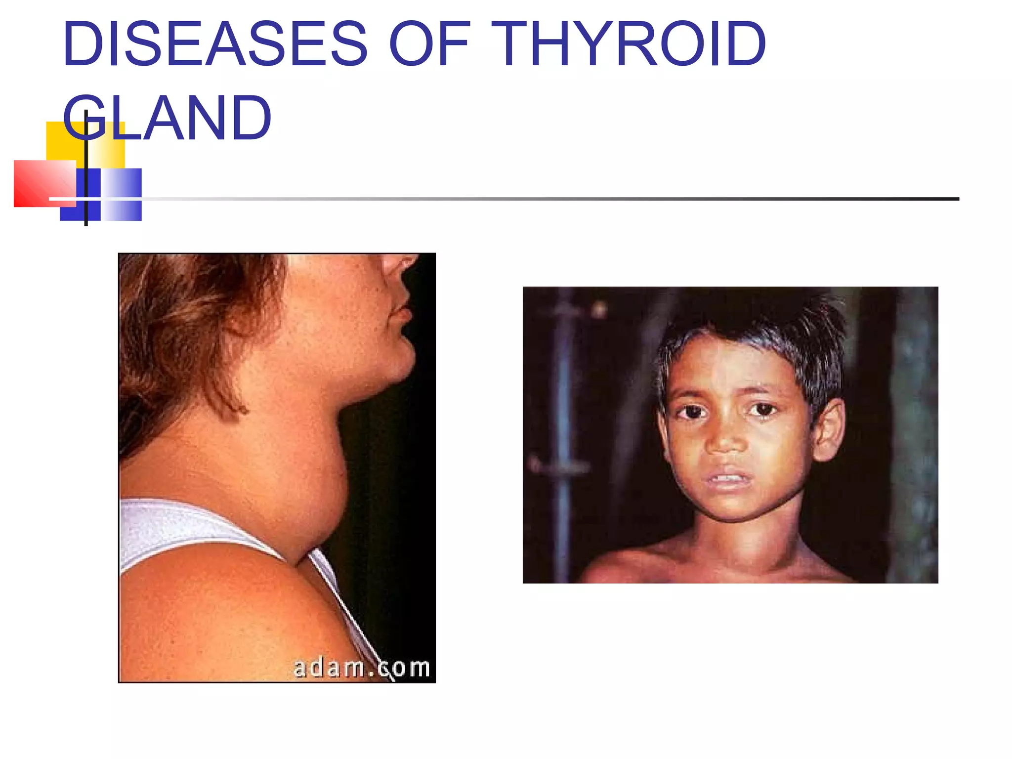 Brief introduction on disorders of thyroid gland | PPT