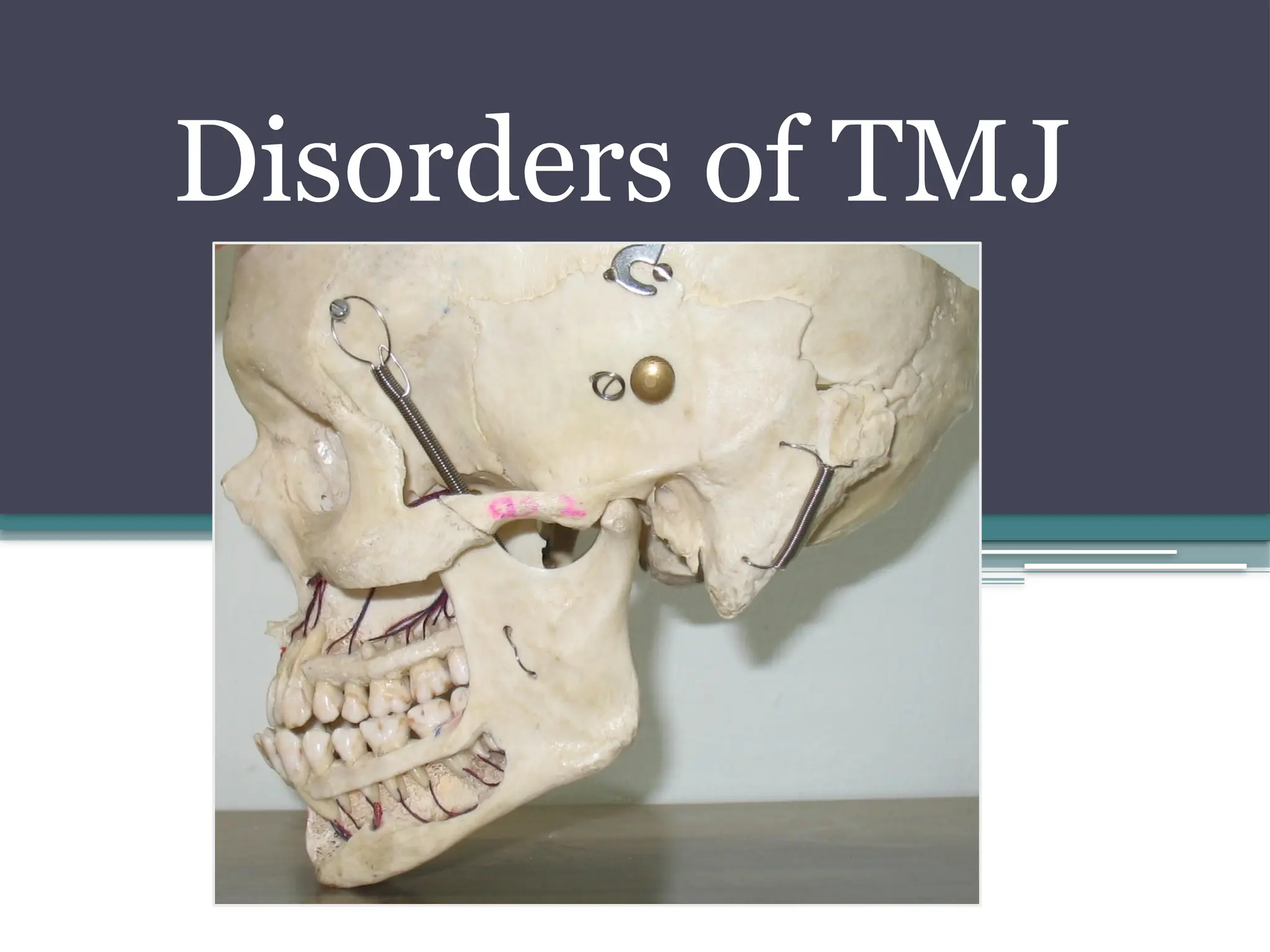 temporo mandibular joint disorders and its histology | PPTX
